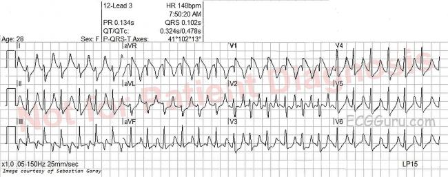 Instructors' Collection ECG: Tachycardia In An Unresponsive Patient ... Instructors' Collection ECG: Tachycardia In An Unresponsive Patient ...